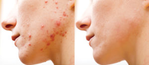 How to Remove Acne in Photoshop - PSD Stack